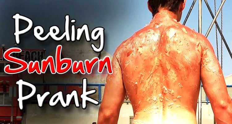 Peeling Sunburn Prank - Badchix Magazine